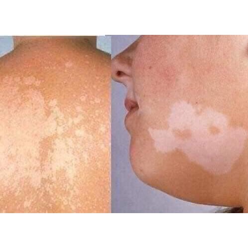 Fango B Thai standard tinea versicolor cream | Shopee Malaysia