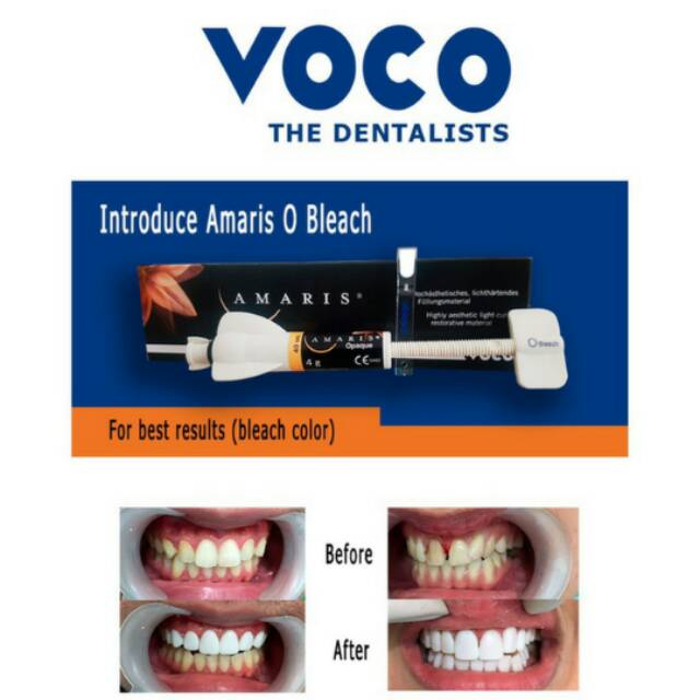 Alice dental // amaris dental veneer composite voco o Bleach/resin ...