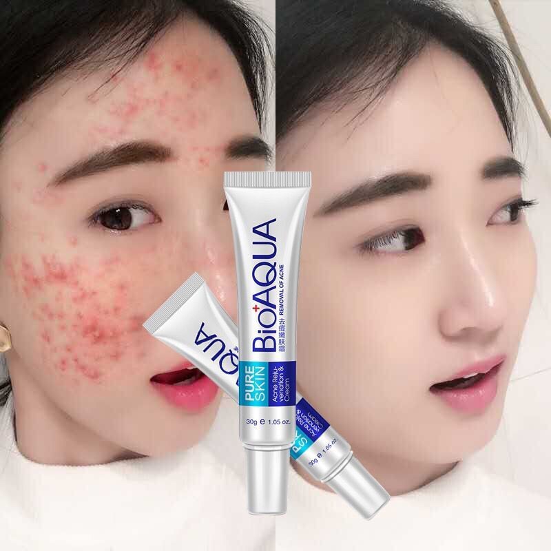 BIOAQUA 🔥 acne cream whitening skin care anti acne treatment cream oil ...