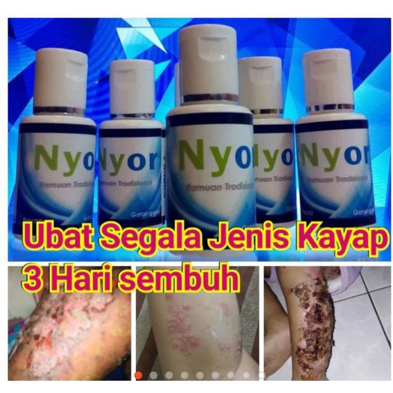 Ubat kayap , Ubat kayap api , Ubat kayap ular & ubat semua jenis kayap ...