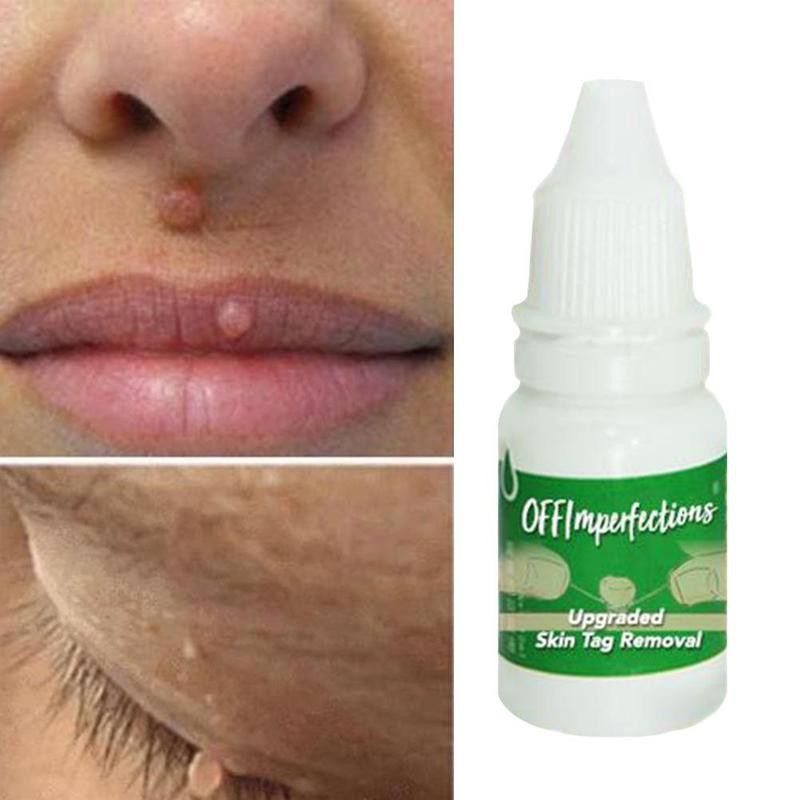 10ml Skin Tag Removal FootCorn Removal Plantar Genital Warts Ointment ...