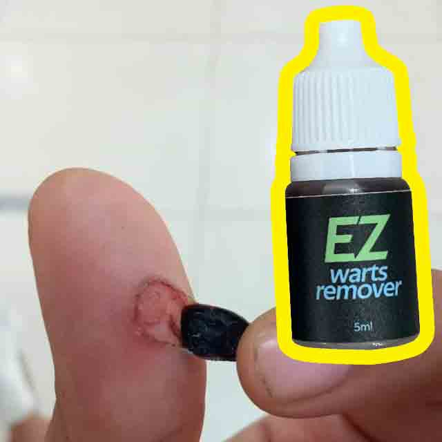 EZ WARTS Remover ORIGINAL Authentic for Warts Moles Skin Tags Nunal NOT ...