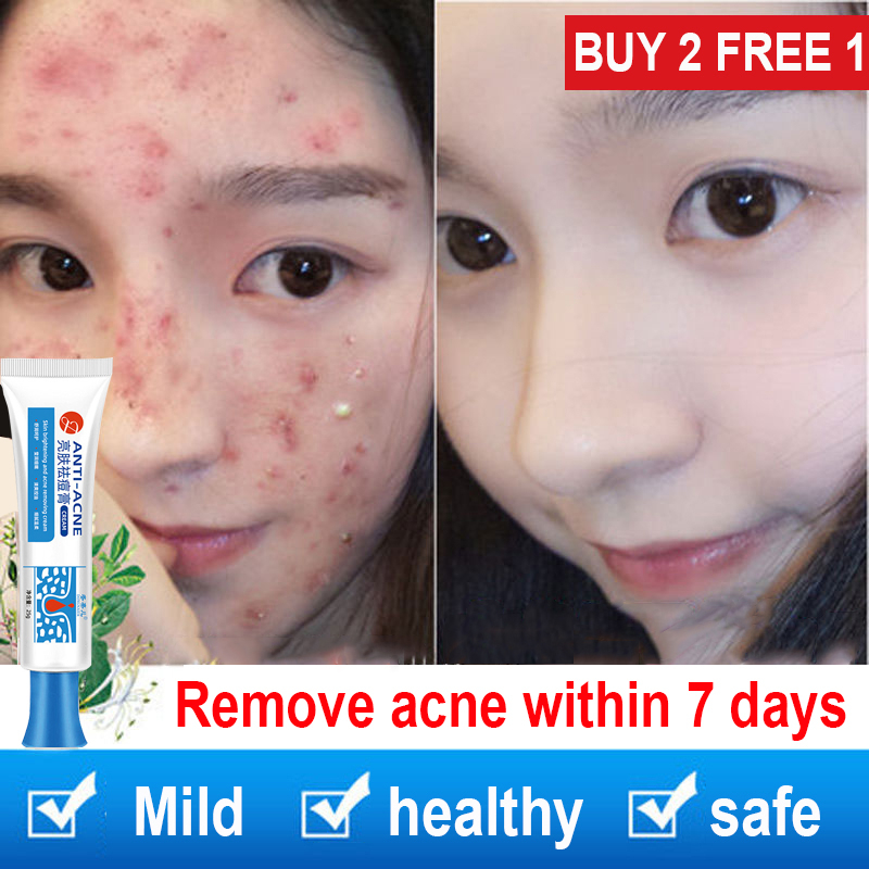 Anti-Acne Cream Acne Treatment Gel Pimple Scars Remover Skin Care ...
