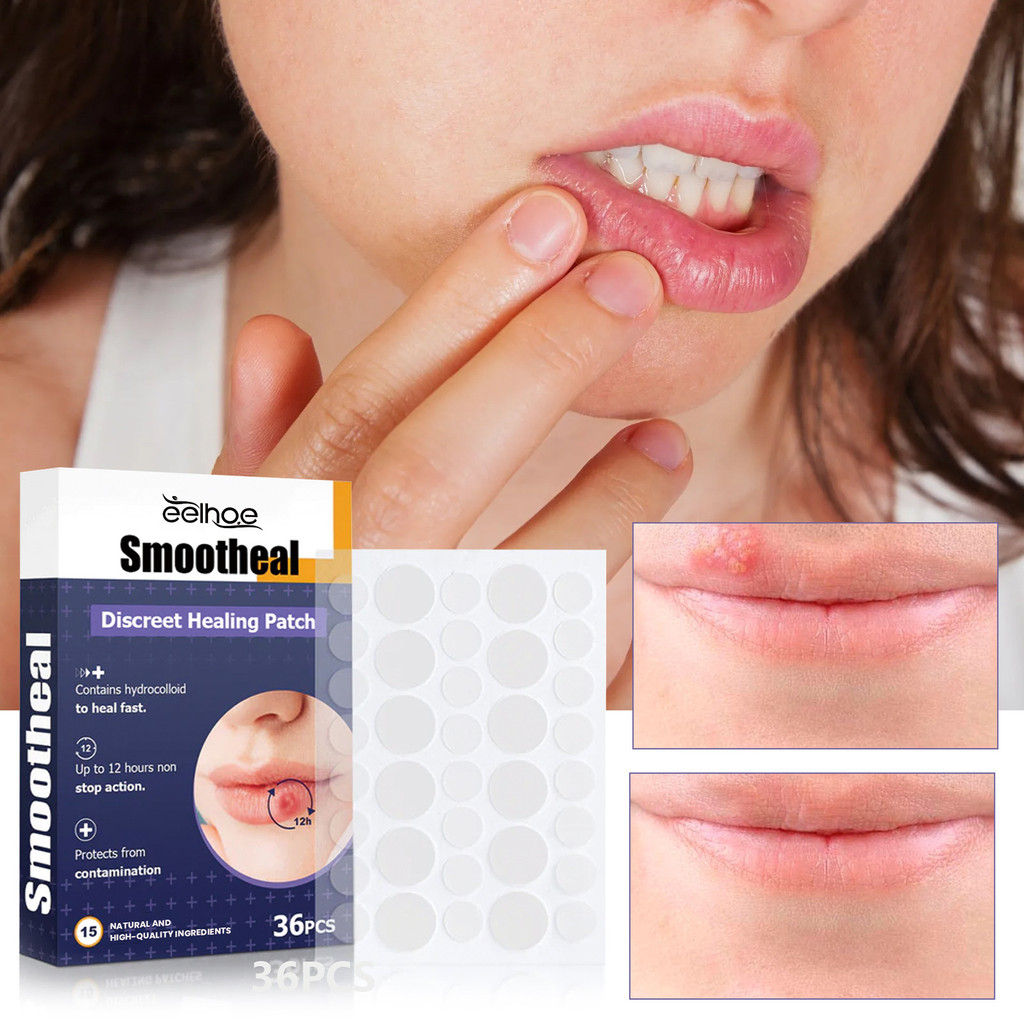 Cold Sore Treatment Patch Help Prevent Breakouts, Soothe Itching and ...