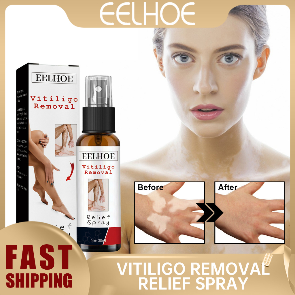 Eelhoe Vitiligo Cream Repair Spray White Tag Treatment | Shopee Malaysia Eelhoe Vitiligo Cream Repair Spray White Tag Treatment | Shopee Malaysia
