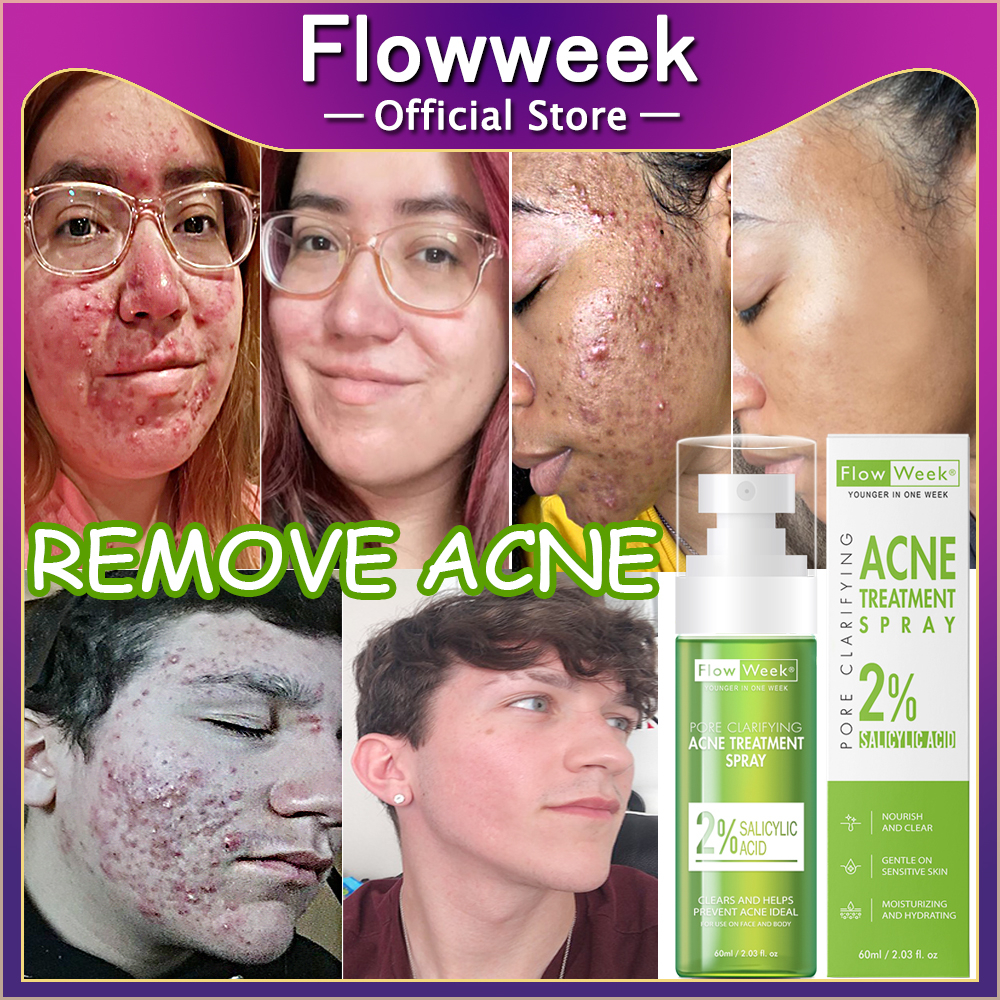 Flow Week 60ml Effective Acne Removal Spray Treatment Acne Scar Spots ...