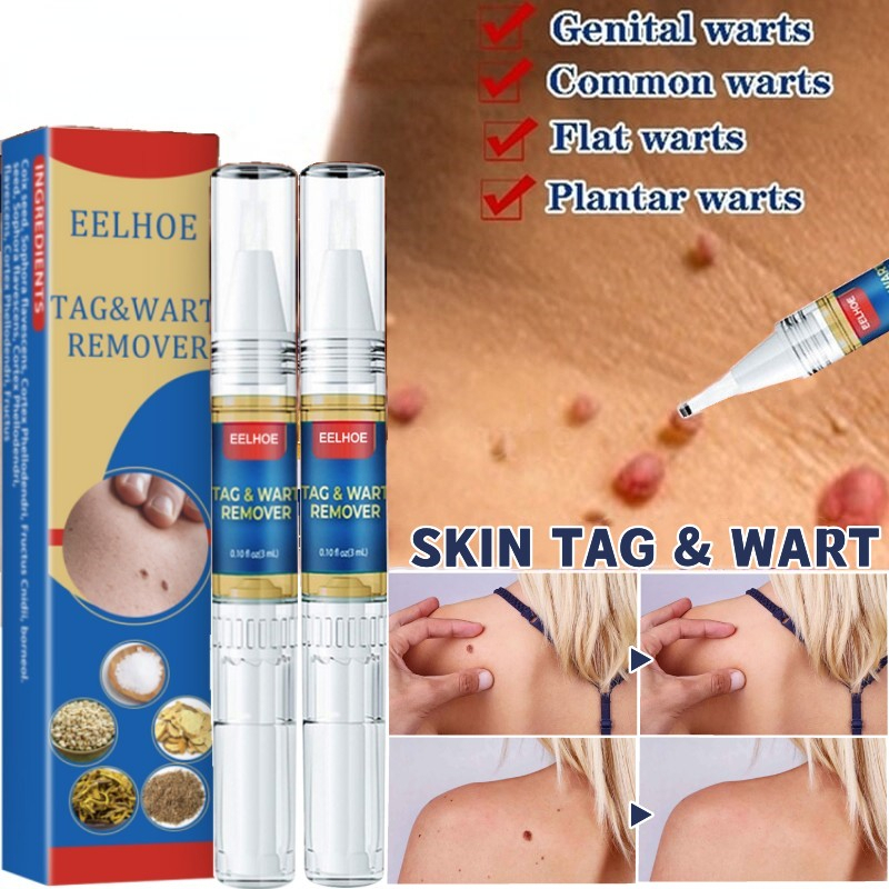 Wart Mole Removal Pen Genital Wart Remover Mole Wart Remover Body Skin ...