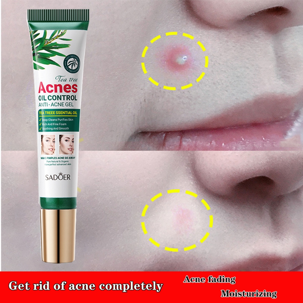 Acne Removing Cream Remove Acne Whelk Acne Cure Chinese Herbal Essence Remove pimples and ...