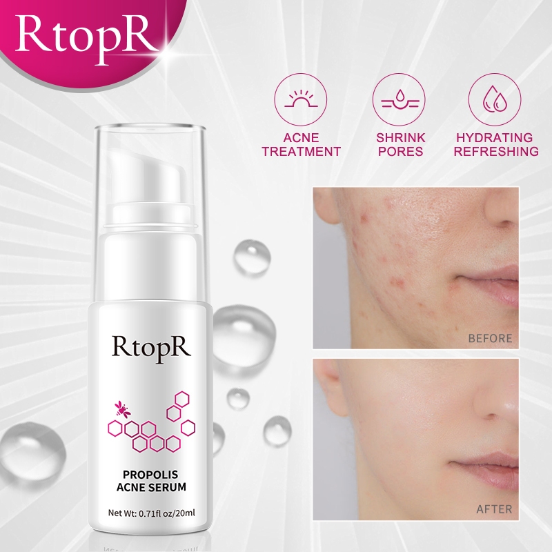 RtopR Propolis Acne Serum Acne Repair Acne Spots Nourishing Skin Anti ...