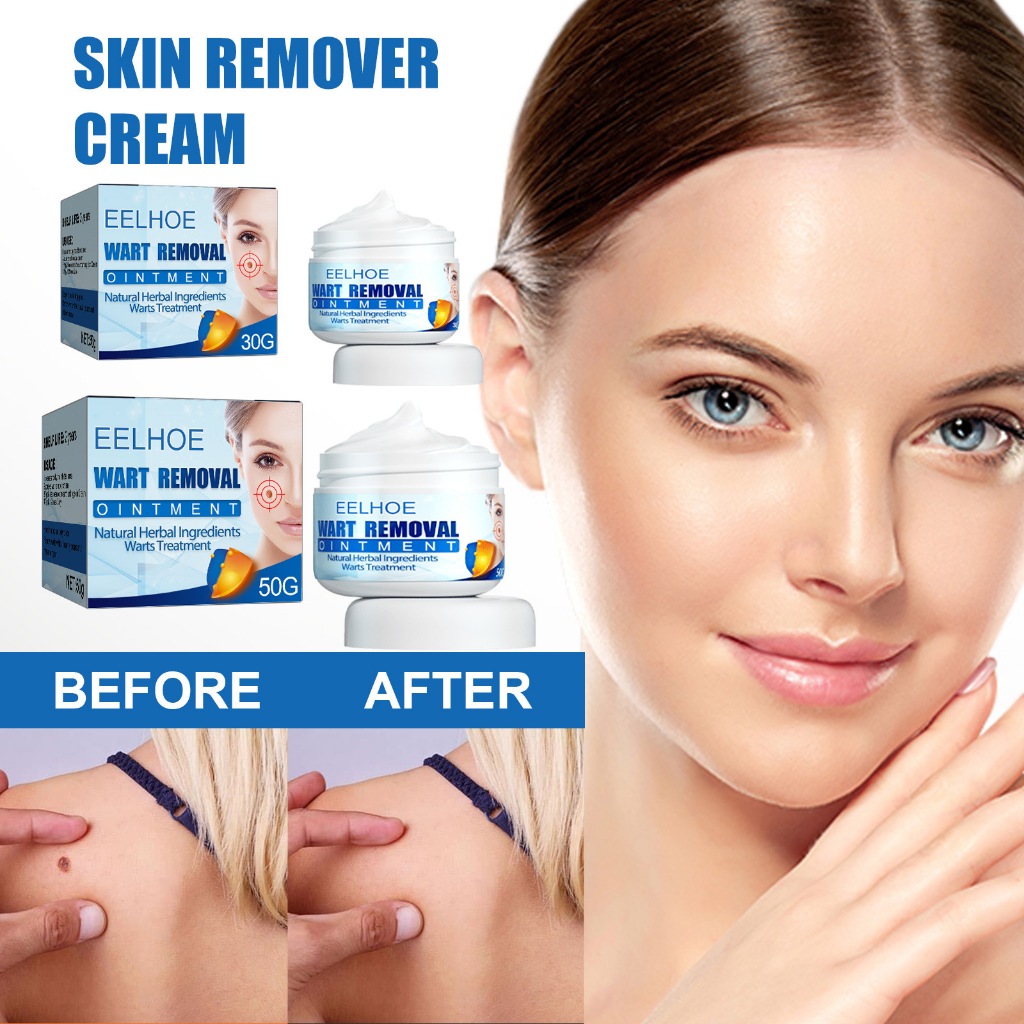 EELHOE Painless Wart Remover Cream Treatment Of The Skin And Flat Warts ...