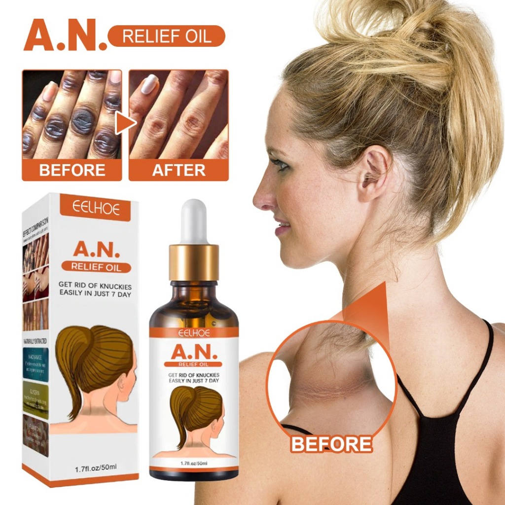 Acanthosis Nigricans Therapy Oil Knee Body Bleaching Dark Knuckle ...