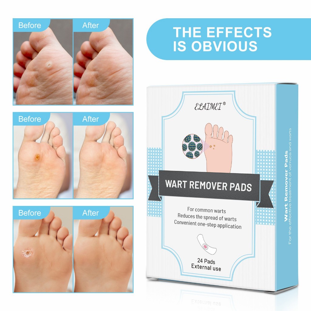 Aliver Corn Removal Patch Toe Callus Corn Remover Pads Wart Treatment ...