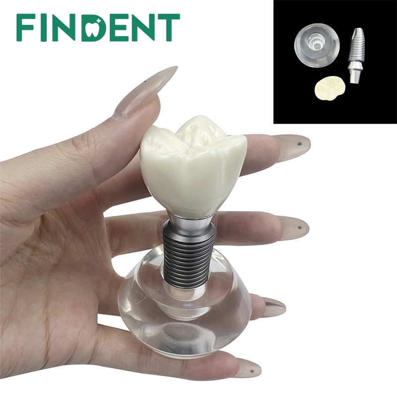 Dental Implant Teeth Model Clear Implant Denture Model Crystal Crown ...