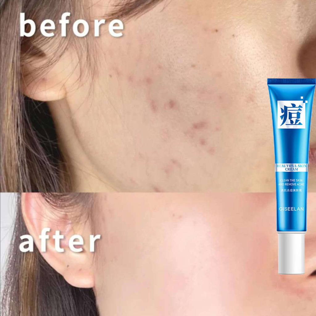 Acne Cream Anti Acne Cream Acne Treatment Serum Acne Treatment Gel Scar ...