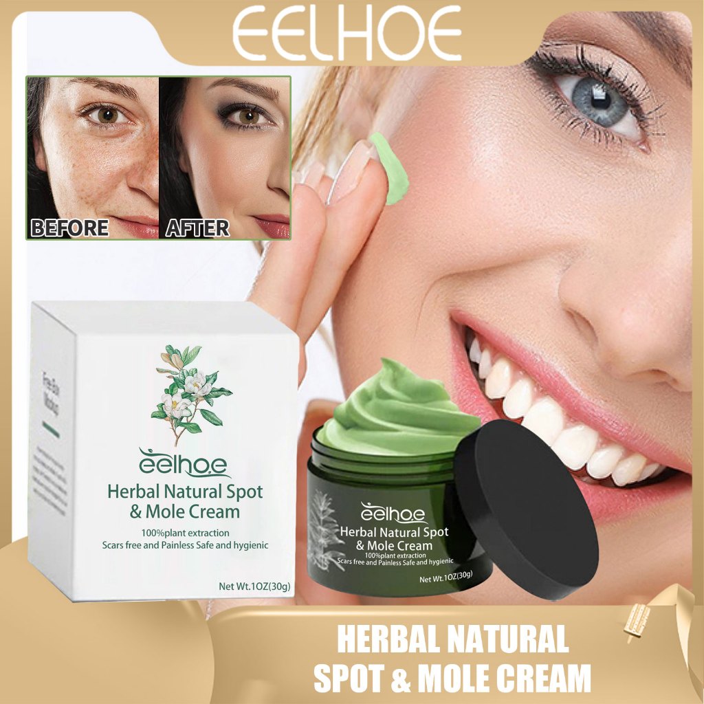 Eelhoe Herbal Natural Spot Cream Vitiligo Cream White Spots Removal ...