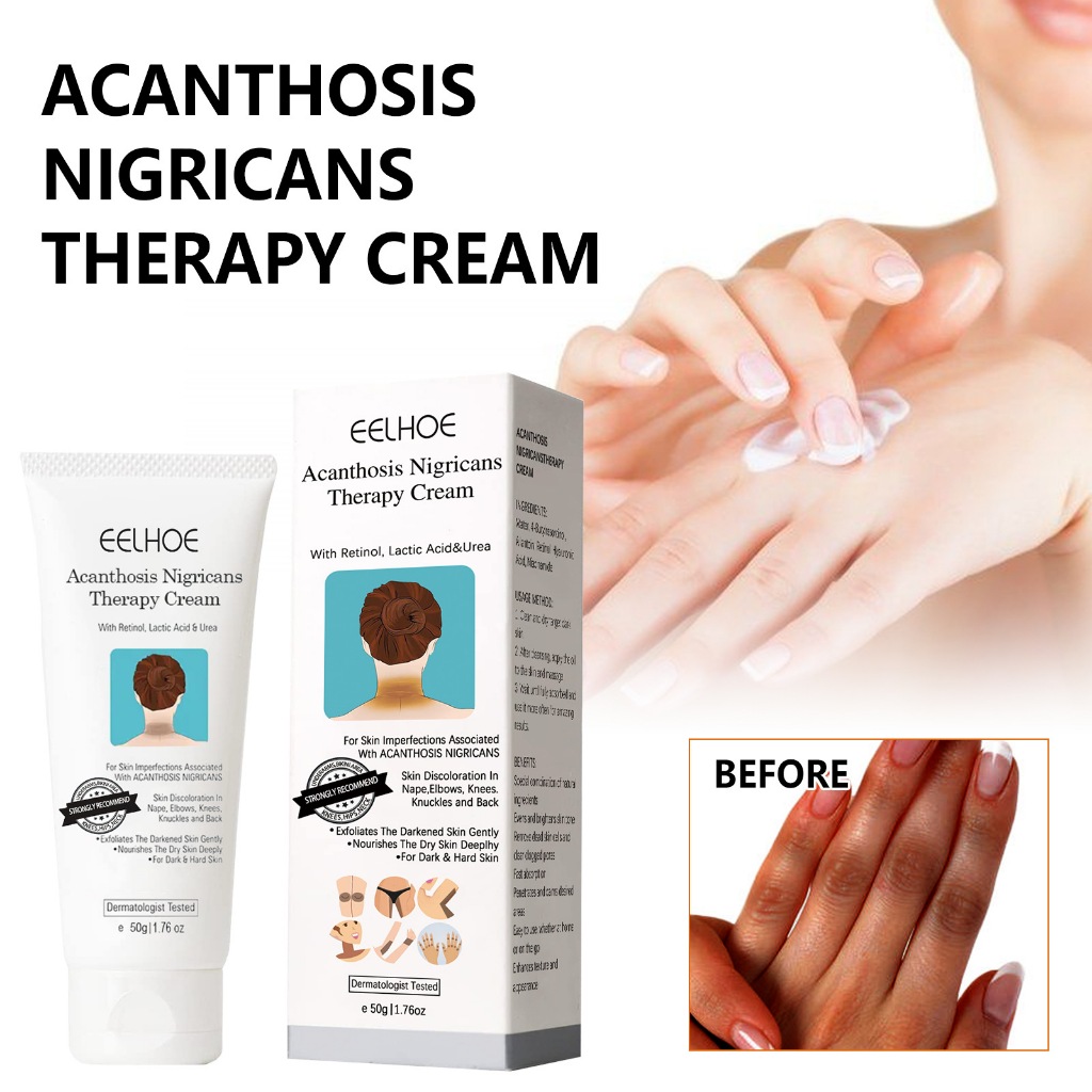 50g Acanthosis Nigricans Therapy Cream,Removal Of Hyperpigmentation ...