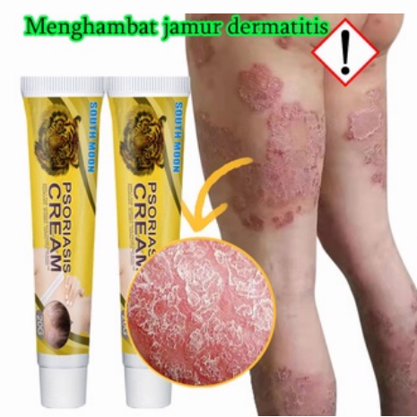 Psoriasis Cream original Eczema Cream krim gatal kulit herba cina kulit ubat psoriasis kulit ...