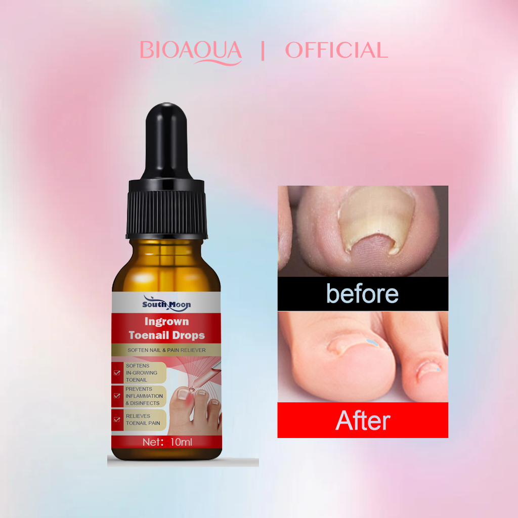 BIOAOUA Ingrown Toenail Drops Ingrown Toenail Remover Treatment ...
