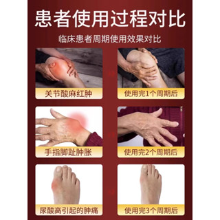 Official genuine gout medical cold compress gel gout joint stiff numb ...