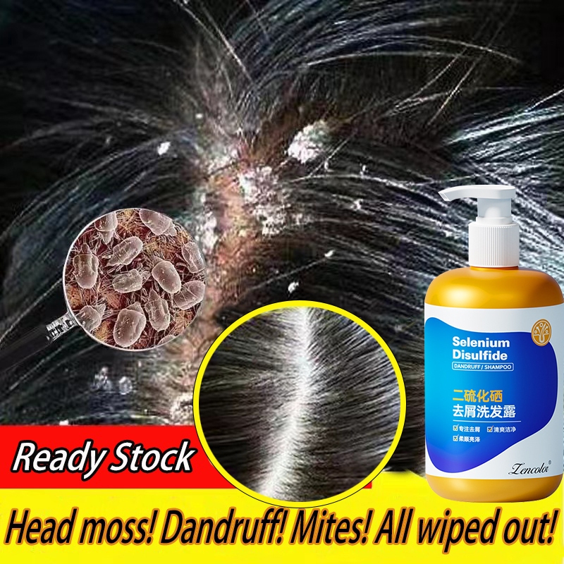 Shampoo Kelemumur Anti Dandruff Shampoo Scalp Shampoo Hair Care Itchy