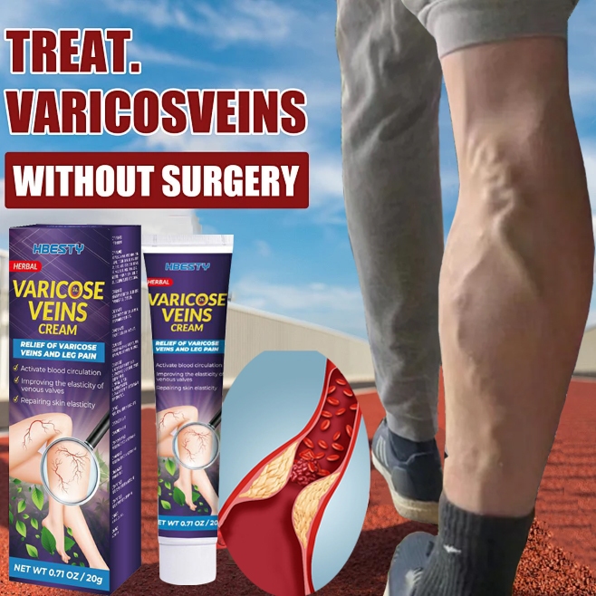 varicose veins cream 20G 靜脈曲張 藥膏 varicose veins treatment Effective ...