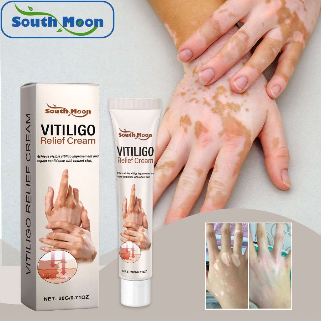 South Moon Vitiligo Relief Cream 20g White Spot Removal Cream Vitiligo ...