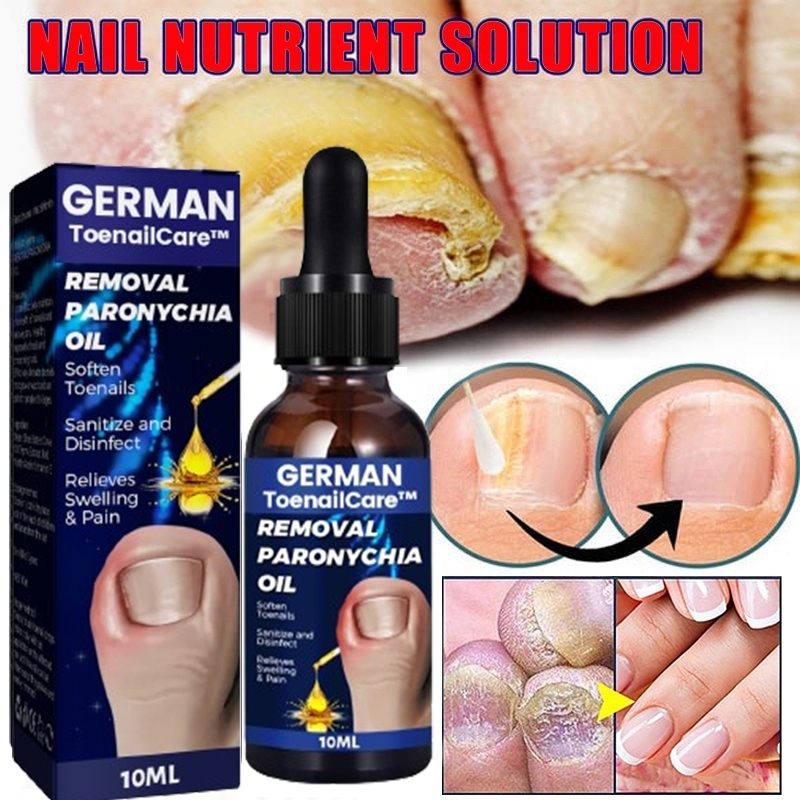 【in stock】Effective Ingrown Nail Oil Toenail Renewal Liquid Anti ...
