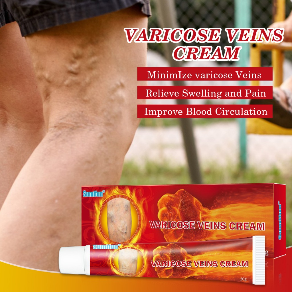 Effective Varicose Vein Relief Cream Eliminate Vasculitis Phlebitis ...