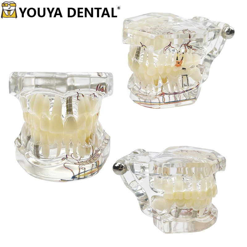 Dental Transparent Teaching Teeth Model Implant with Nerve Pathological ...