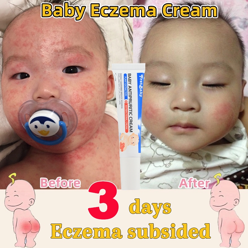 Baby eczema cream 15g remdii eczema itchy skin cream itch relief rash ...