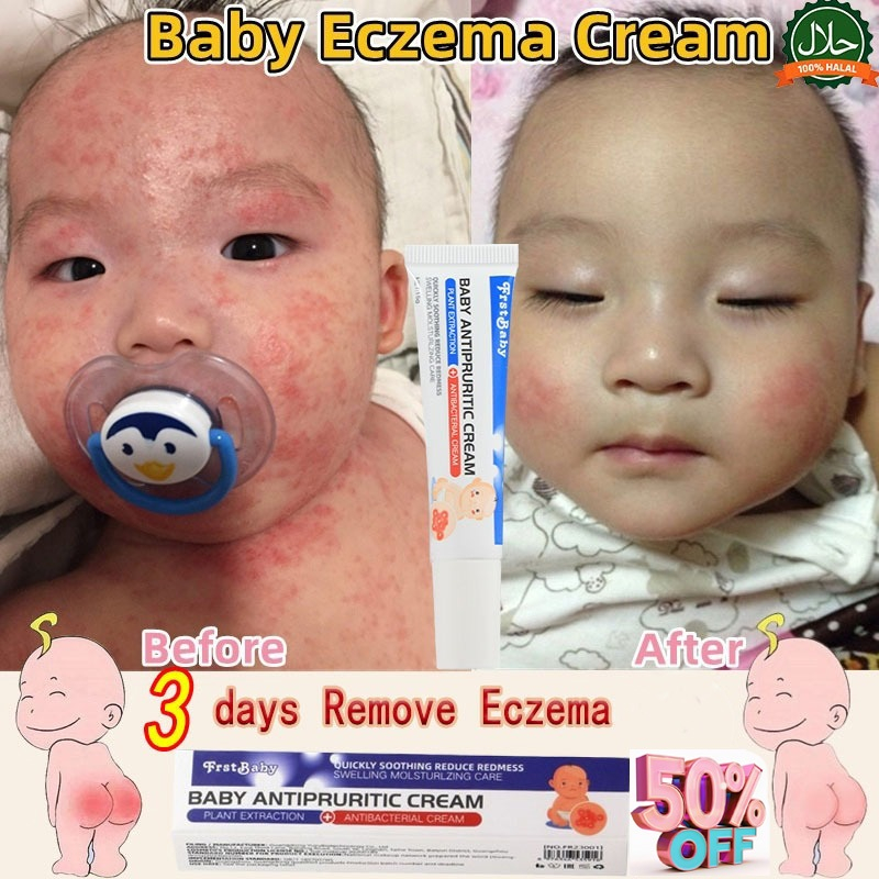 Skin ointment for infants and young children Eczema cream 15g Baby ...