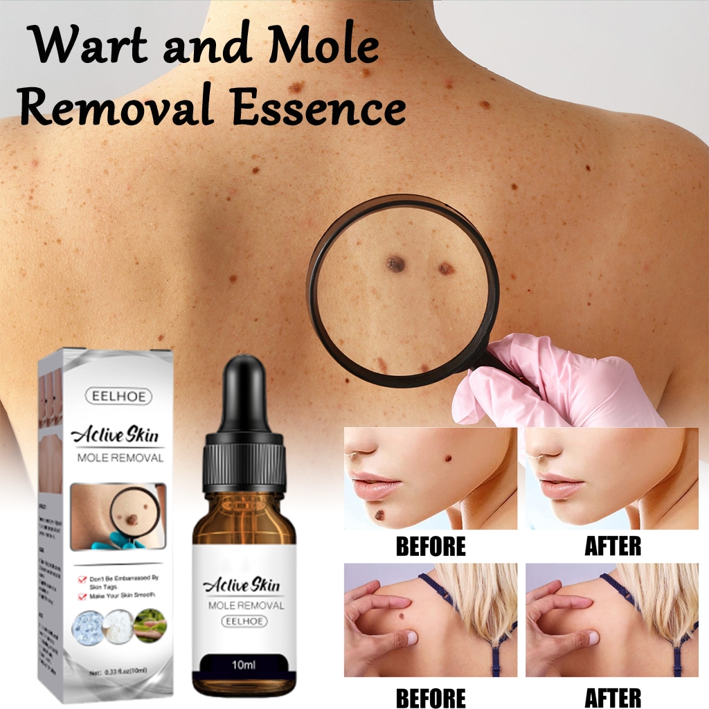Aclive Skin Mole Removal Essence Skin Tag Remover Mole & Genital Wart ...