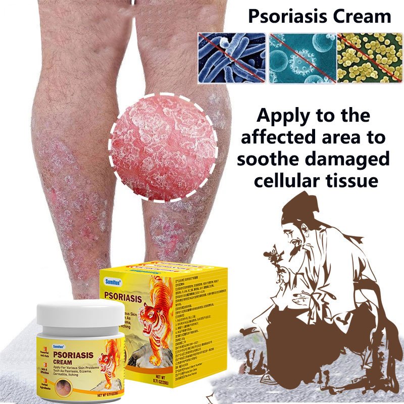 Psoriasis Cream Antifungal cream Eczema cream 20g 草本精华 Anti-itch cream ...