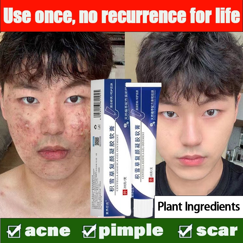 Acne Cream 20g Quick Acne Treatment Pimple Cream Plant Ingredients No ...