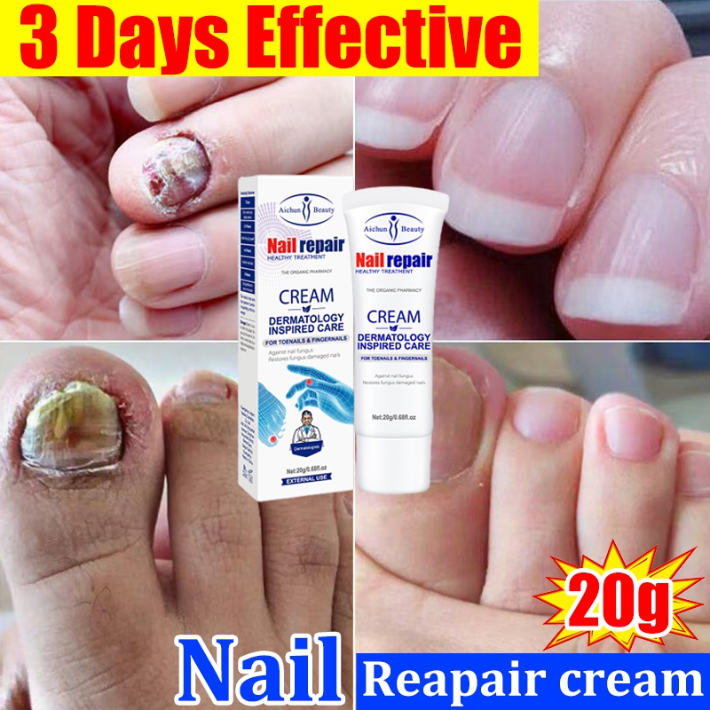 Ubat Kuku Rosak Fungus Ingrown Toenail Nail Fungus Treatment Ubat Kuku ...