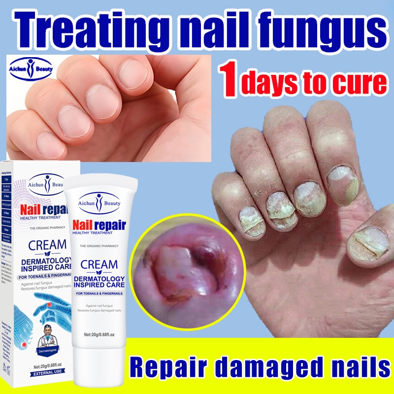 Cure onychomycosis in 5 days Nail Fungus Treatment Ubat kuku rosak ...