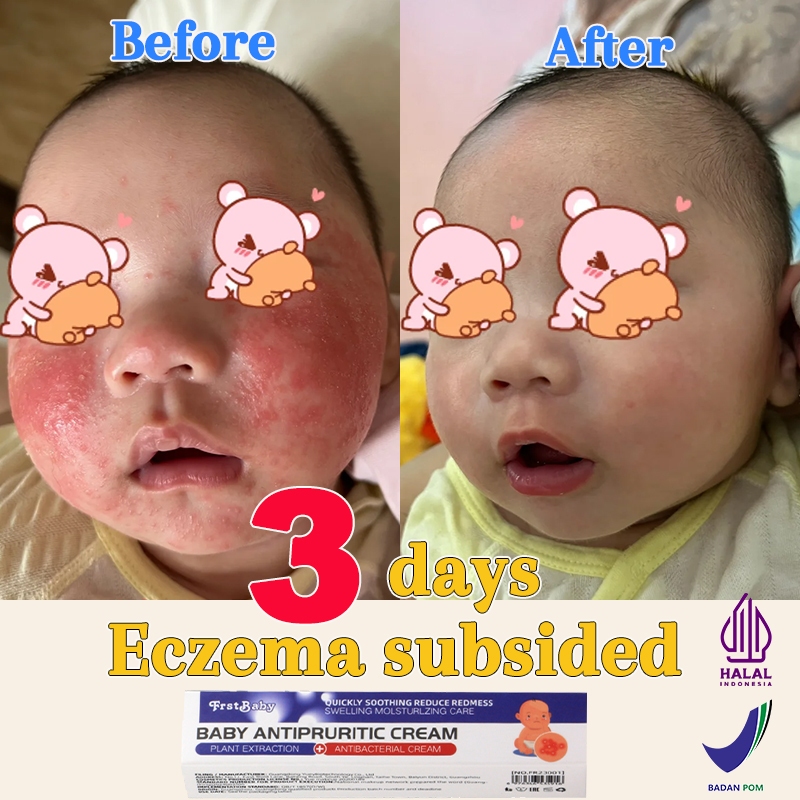 Baby eczema cream 15g anti-itch cream itchy skin cream remdii eczema ...