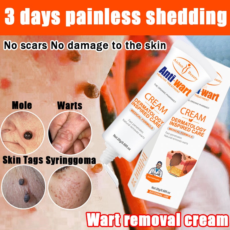 Falls off naturally in 3 days Warts Removal Cream Safe and painless ...