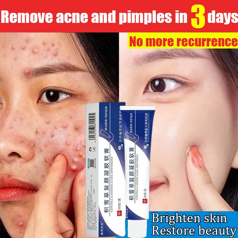 3 Days Fast Acne Treatment Acne Cream 20g Pimple Cream Acne Spot ...
