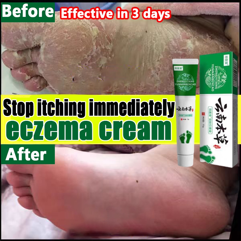 Stop itching immediately Ubat kulat air kaki Eczema Cream Plant formula ...
