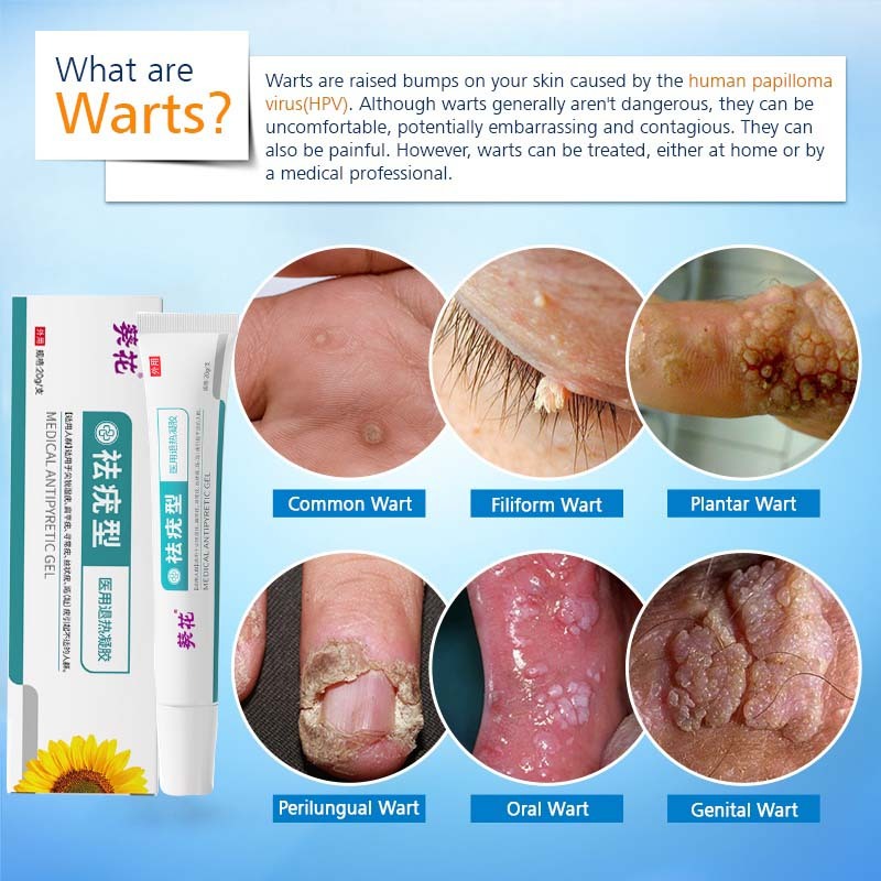 3-Day Effective, Painless Warts Removal Cream Wart Removal 克疣膏 跖疣 刺肉 鸡眼 ...