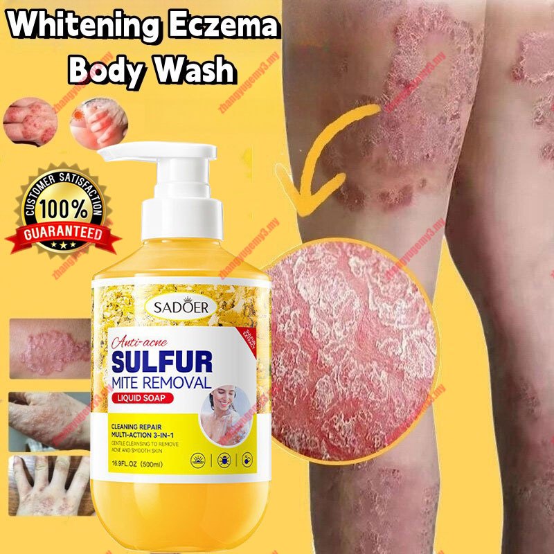 Acne body wash Eczema body wash Sabun gatal kulit paling berkesan500ml Psoriasis body wash ...