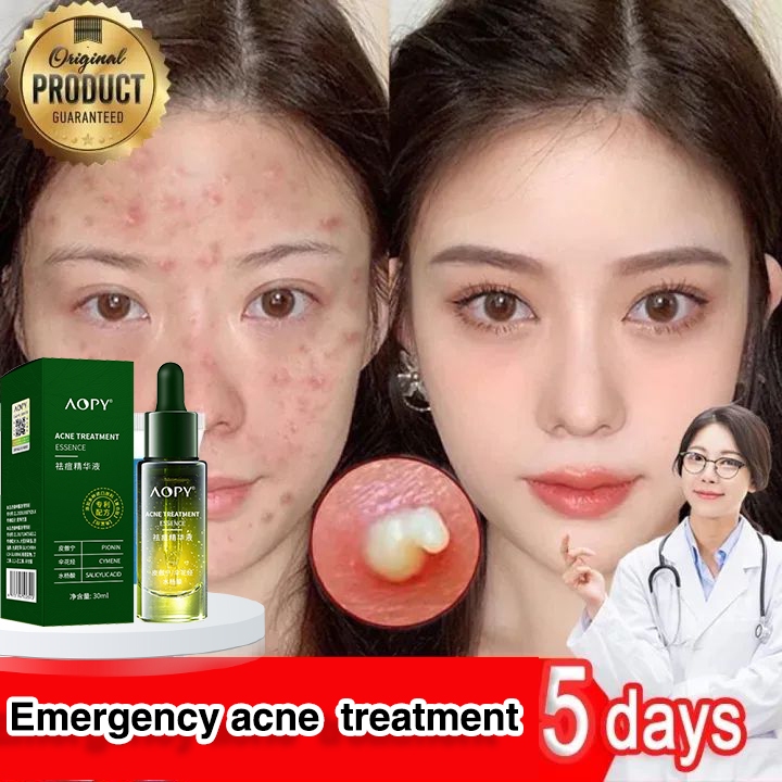 Acne-removing Acid Power Clear Acne Serum Acne Serum pimple cream 30ml ...