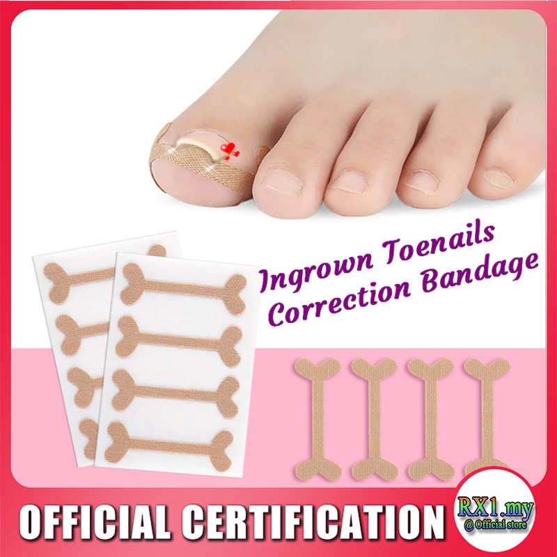 Ingrown Toenails Band Aid Relief Pain Paronychia Correction Pedicure ...