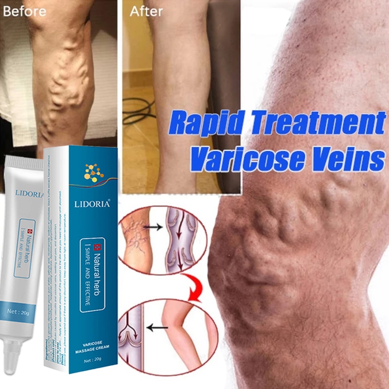 Venous Massage Varicose Cream Relieve Leg Vascular Protrusion Choroid ...