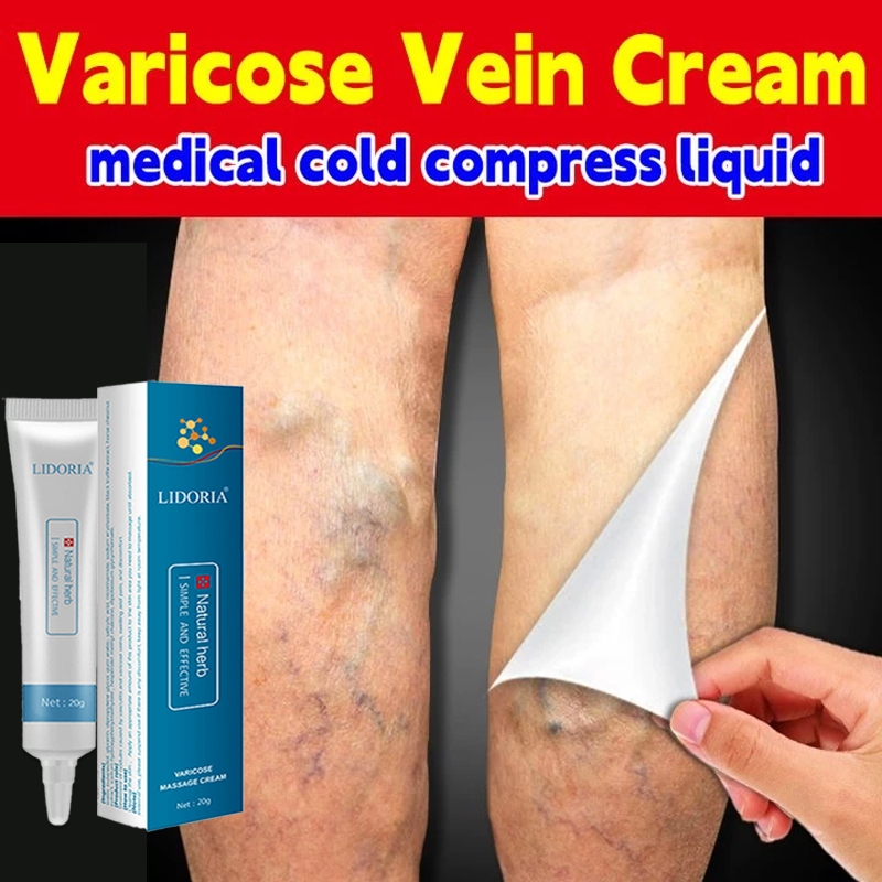 Varicose Veins Cream Portable Varicose Veins by blood stasis andweak ...
