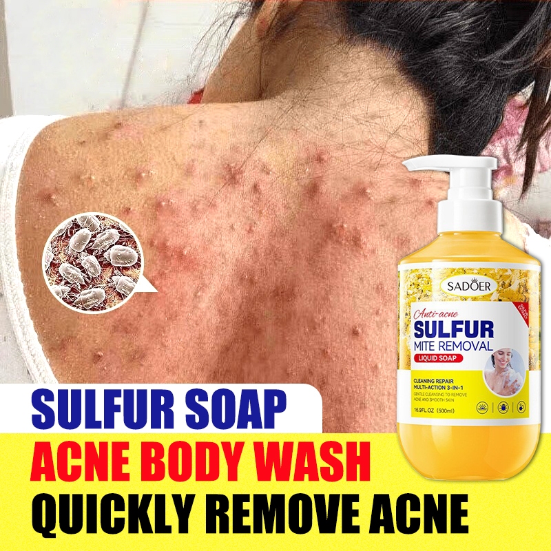 Sulfur Soap Acne Body Wash Oil control for the whole body Anti-itching ...