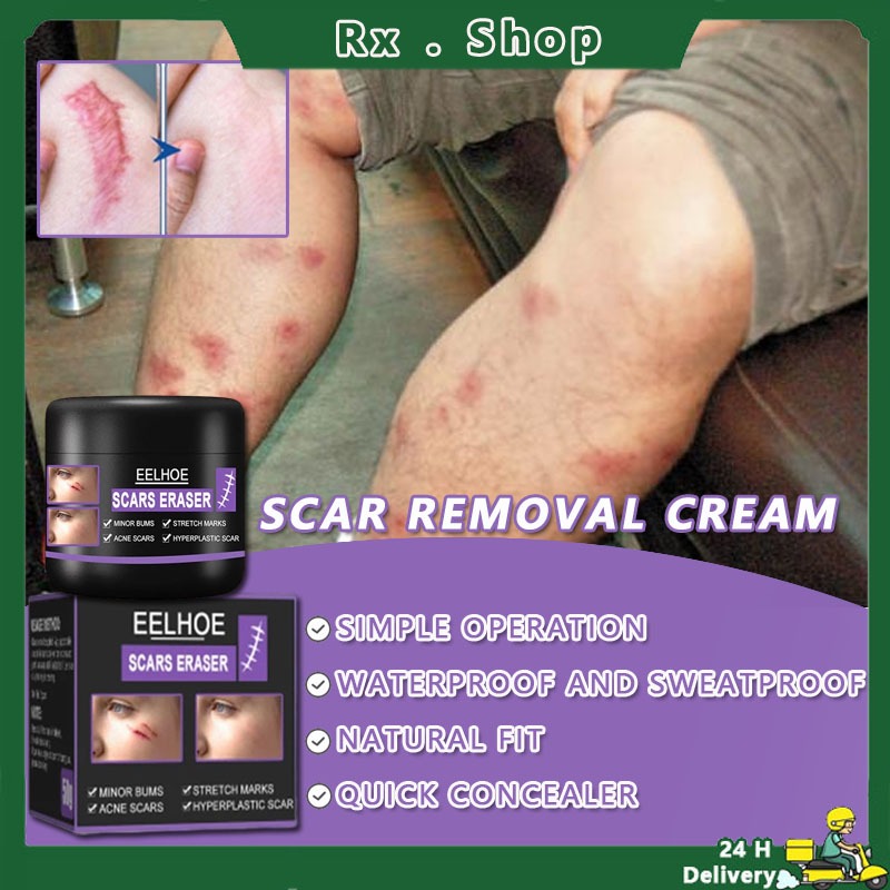 Scar Removal Cream Repair Old Scars Krim Hilangkan Parut Hitam Fades ...