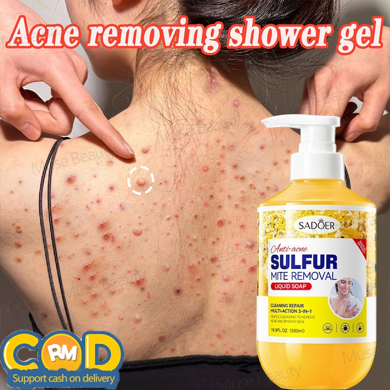 Acne body wash Sabun badan jerawat 500ml acne treatment Relieves ...