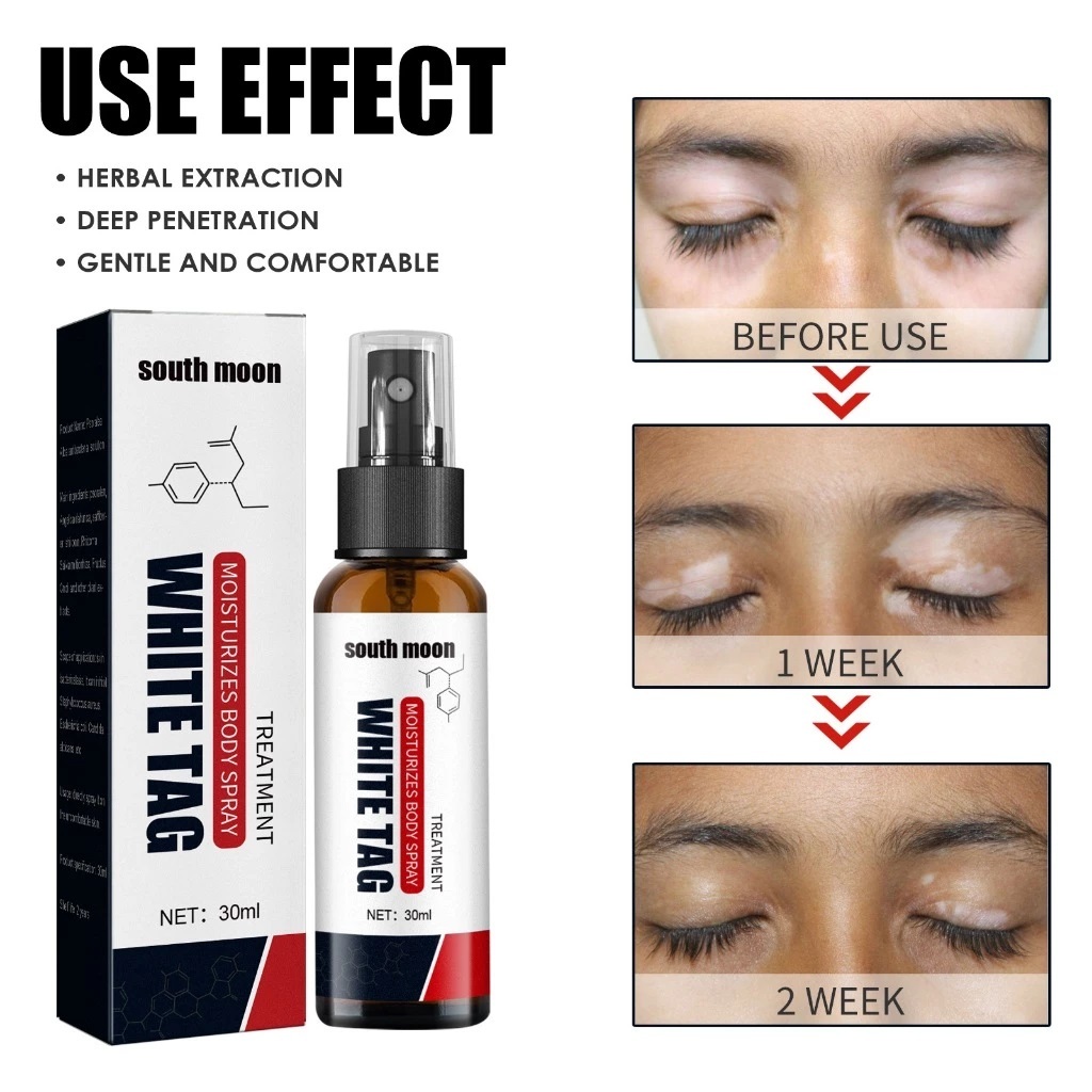In stock 30ml Vitiligo Health vitiligo spray vitiligo remover even skin ...